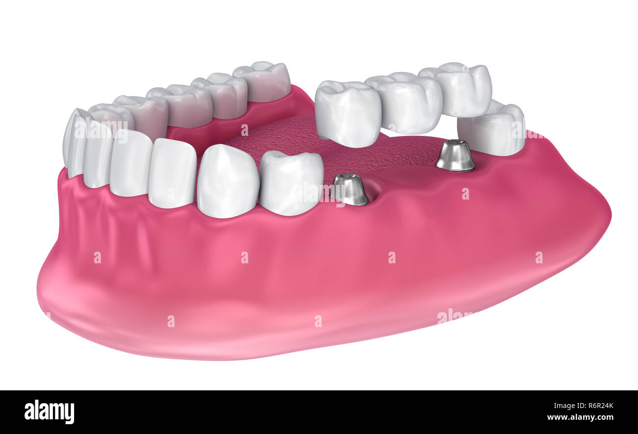 implant supported fixed bridge. Medically accurate 3D illustration ...
