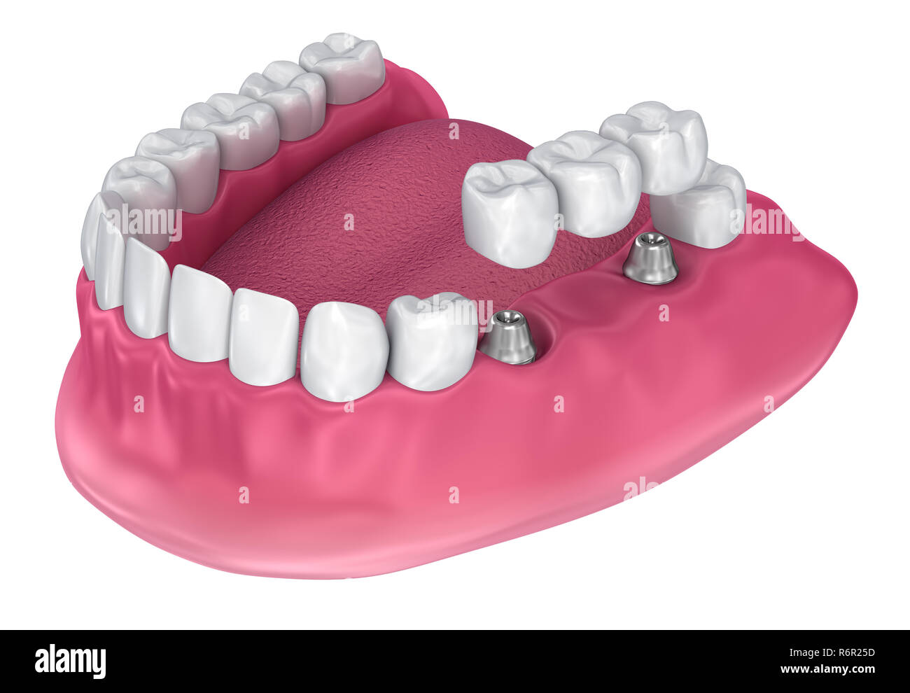 implant supported fixed bridge. Medically accurate 3D illustration ...