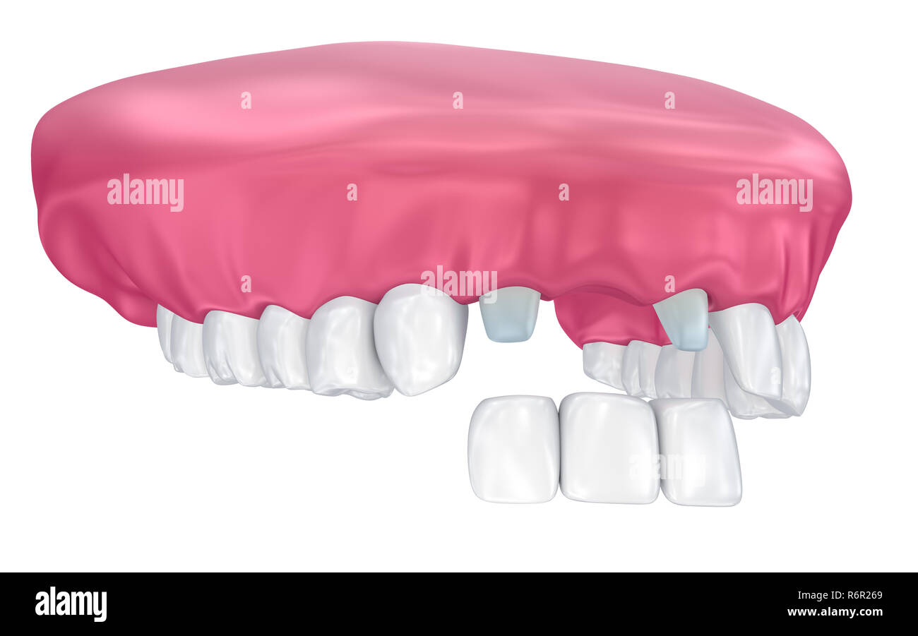 Tooth supported fixed bridge. Medically accurate 3D illustration Stock ...