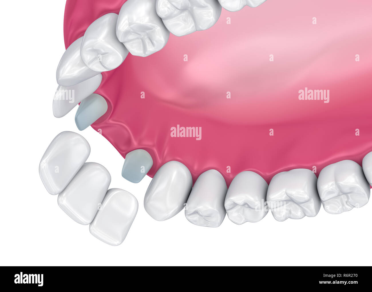 Tooth supported fixed bridge. Medically accurate 3D illustration Stock ...