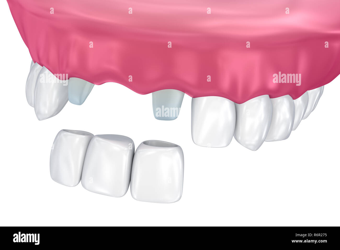 Tooth supported fixed bridge. Medically accurate 3D illustration Stock ...
