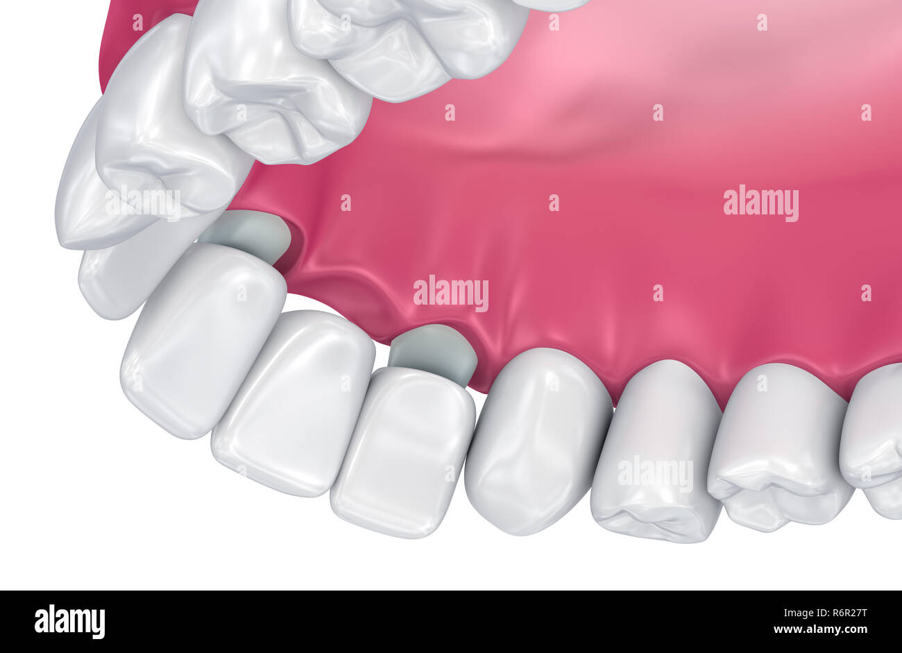 Tooth supported fixed bridge. Medically accurate 3D illustration Stock ...