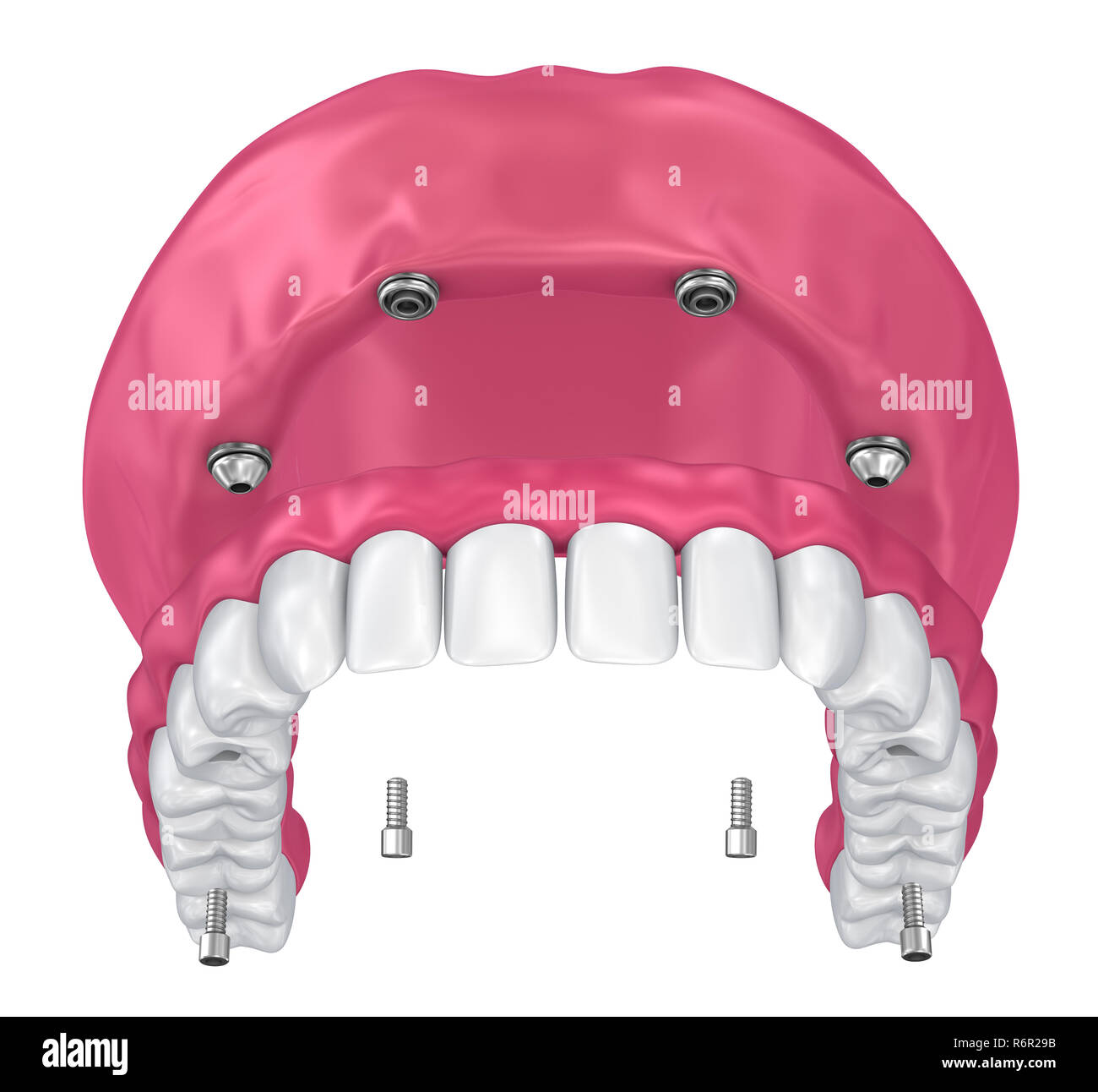 Overdenture to be seated on implants attachments. 3D illustration Stock ...