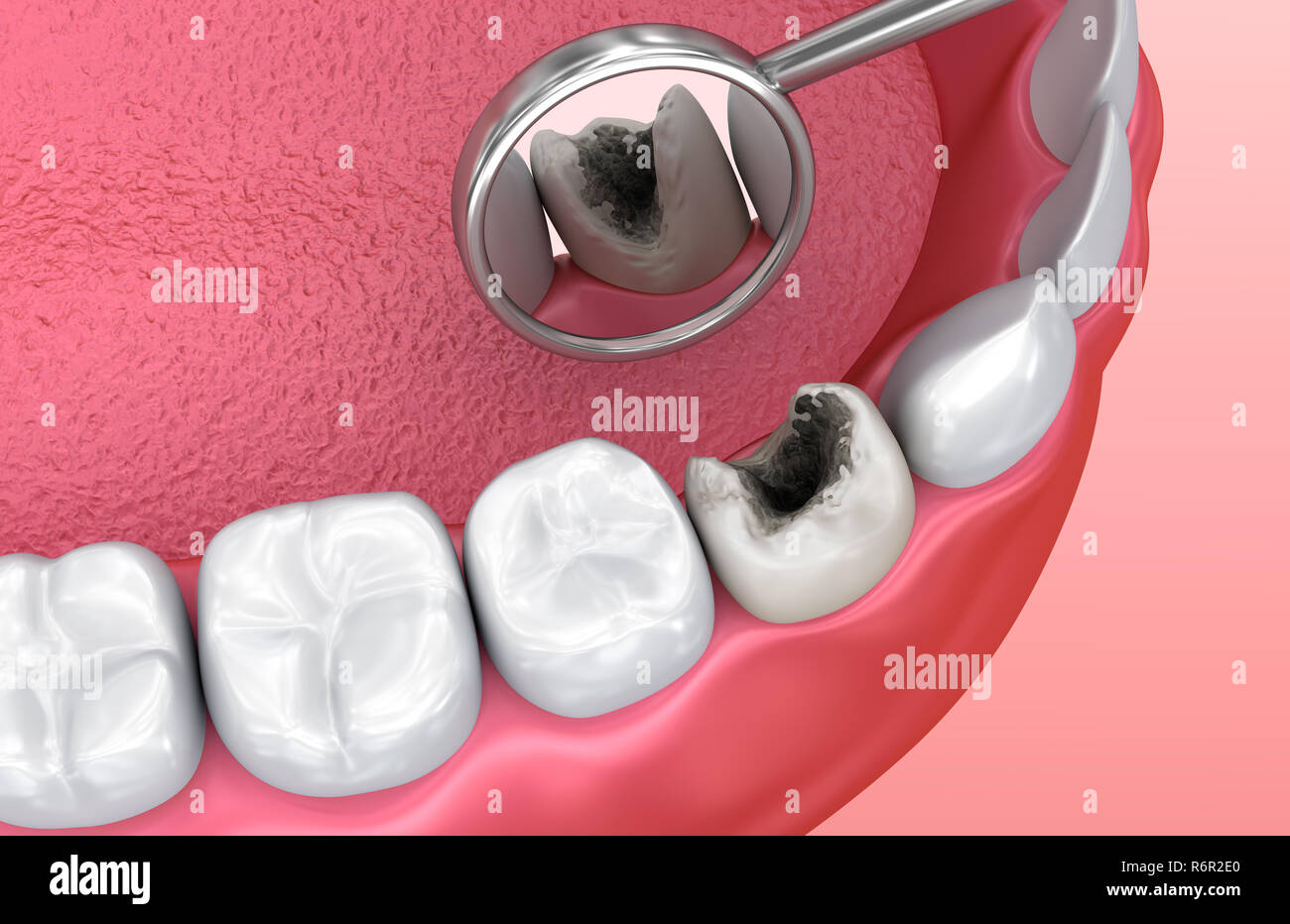 Teeth inspection with mirror. Medically accurate tooth 3D illustration ...