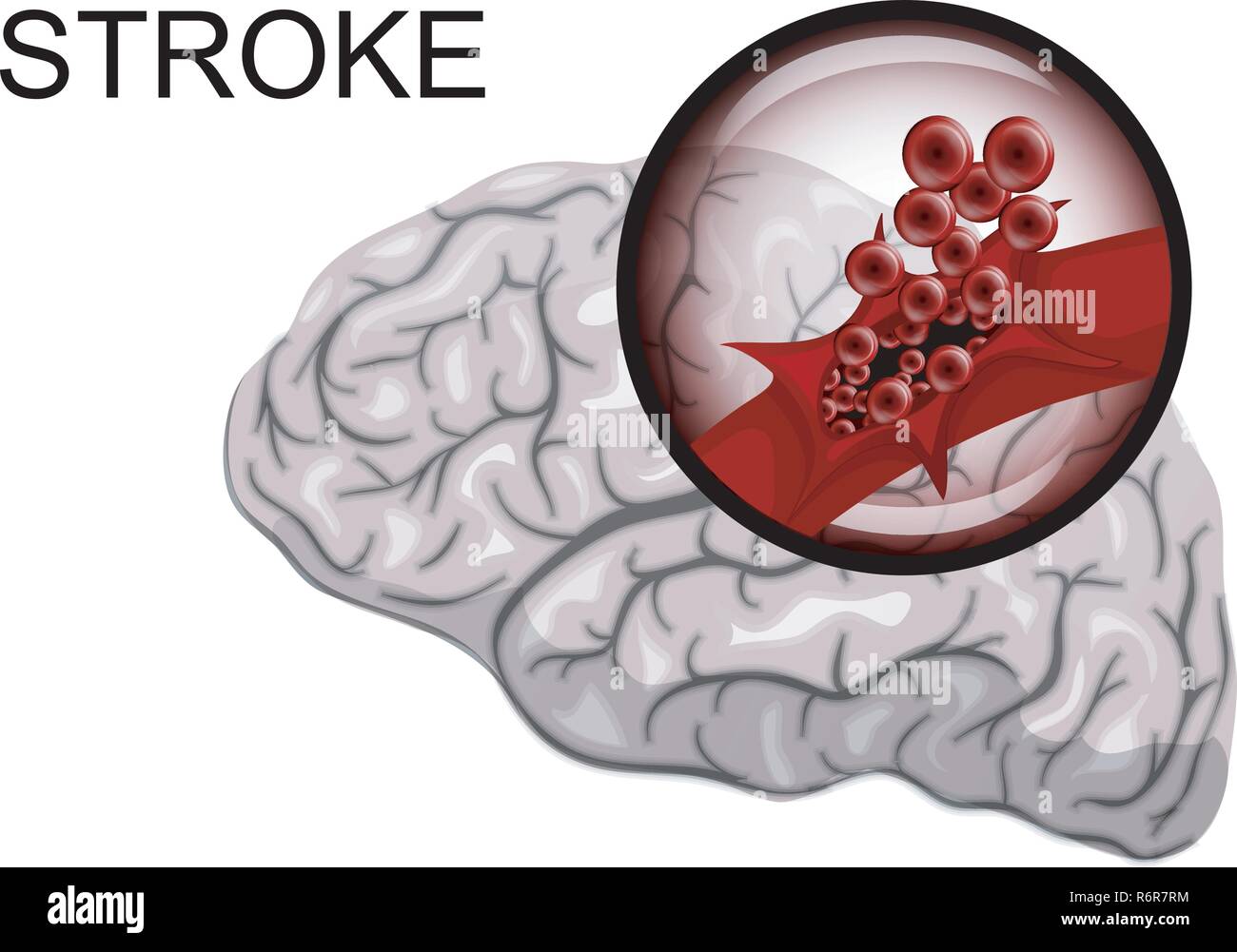 Hemorrhagic stroke hi-res stock photography and images - Alamy