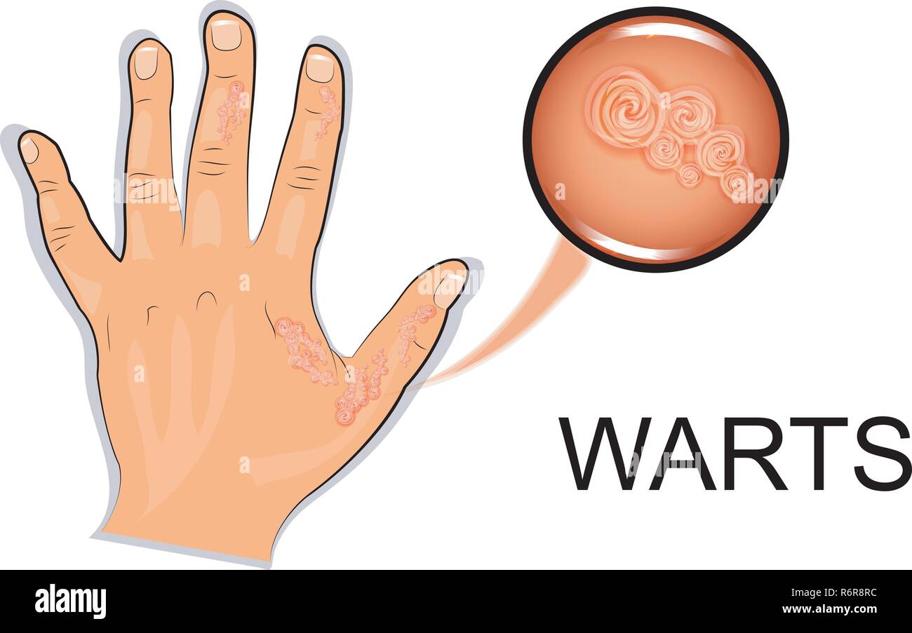 illustration of a hand affected by the wart Stock Vector Image & Art ...