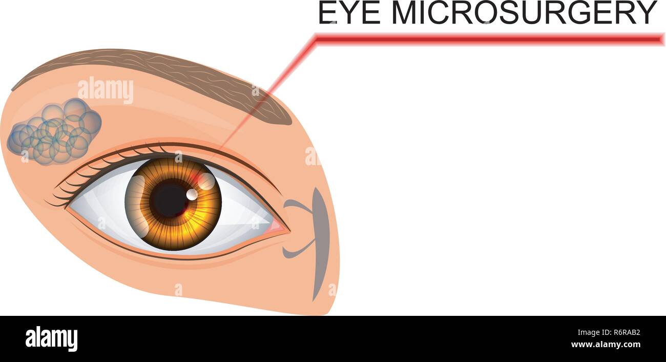 vector illustration of eyes. microsurgery in ophthalmology. for medical ...