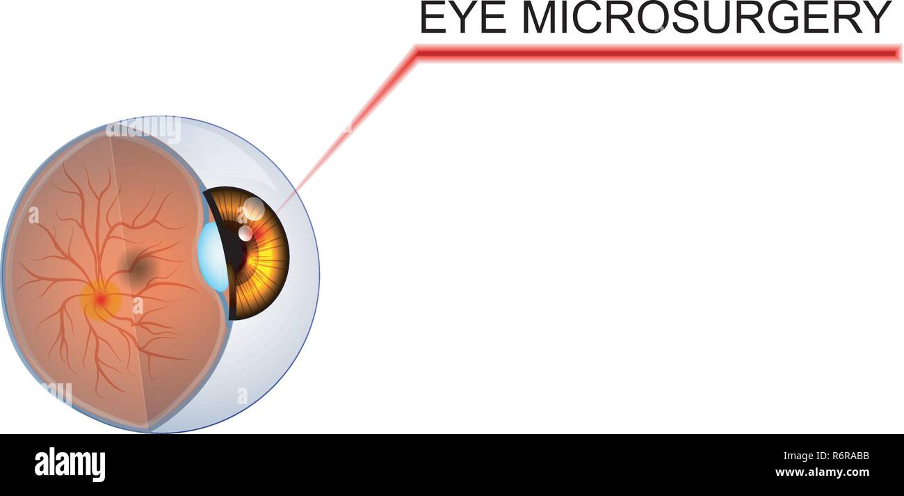 vector illustration of eyes. microsurgery in ophthalmology. for medical ...