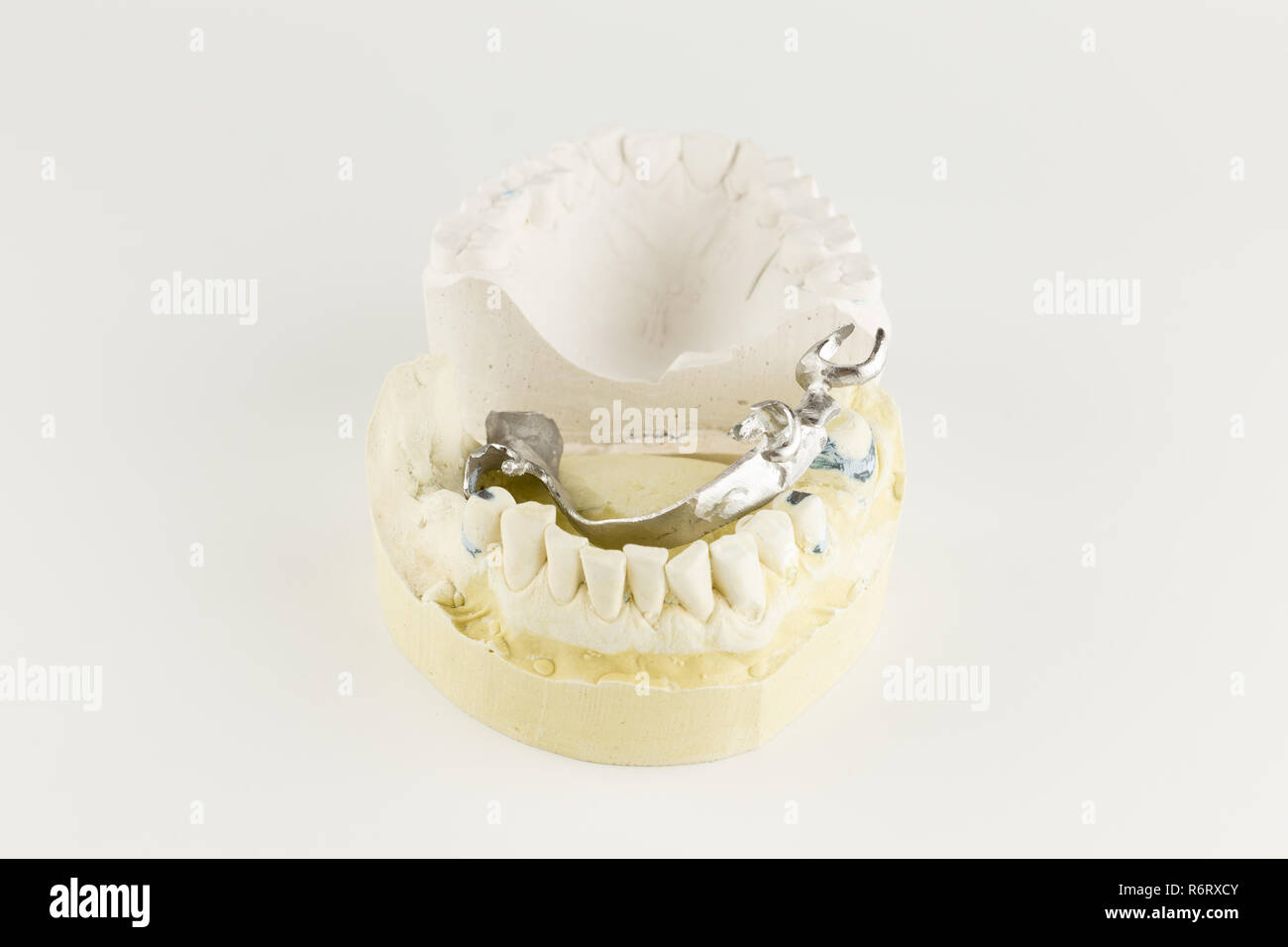 steel base of the clasp prosthesis on the gypsum model Stock Photo - Alamy