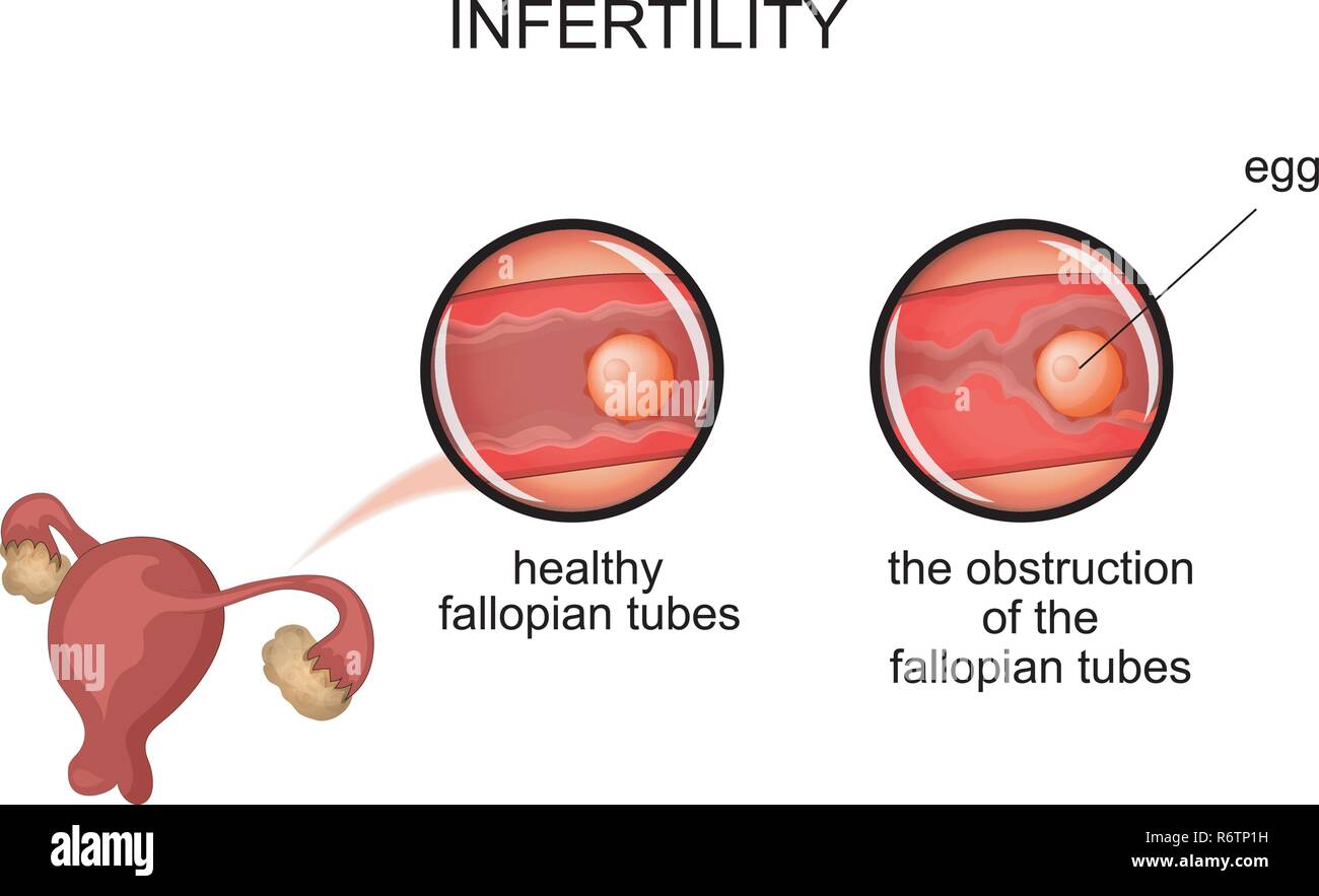 Fallopian tube hi-res stock photography and images - Alamy