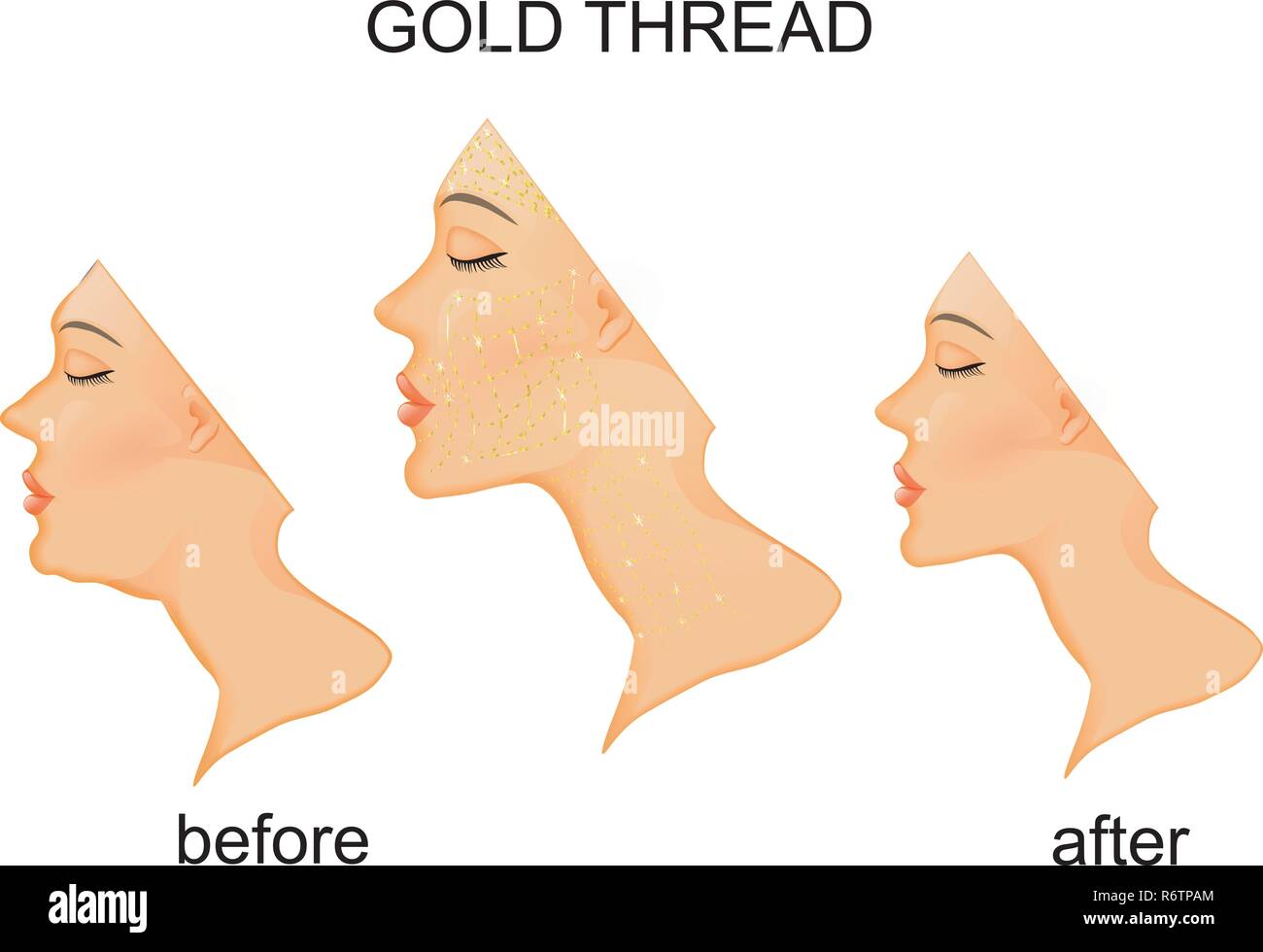 illustration of facial rejuvenation and neck with gold thread.before ...