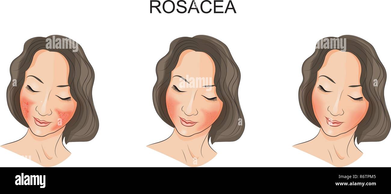 Rosacea hi-res stock photography and images - Alamy