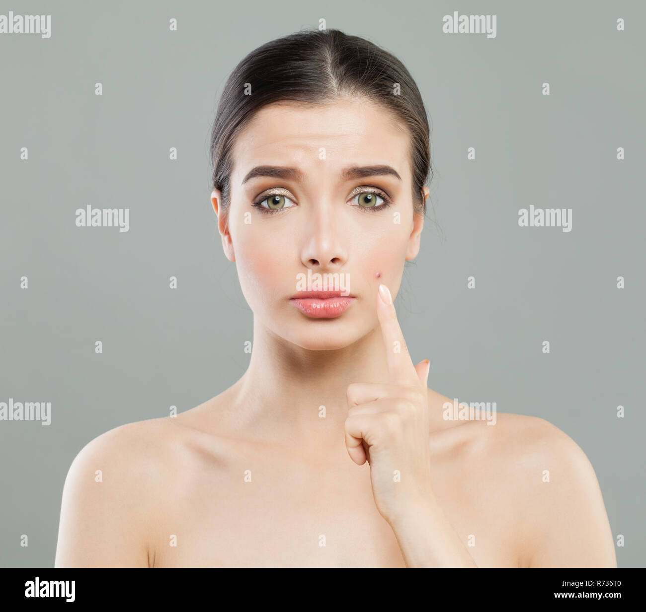 Young woman with acne pimple. Female skin problem. Facial treatment ...