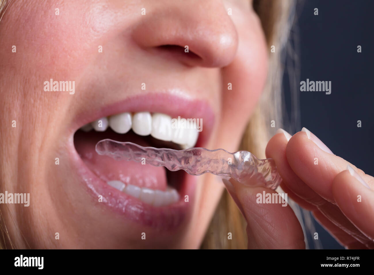 Woman Wearing Clear Aligner Stock Photo - Alamy