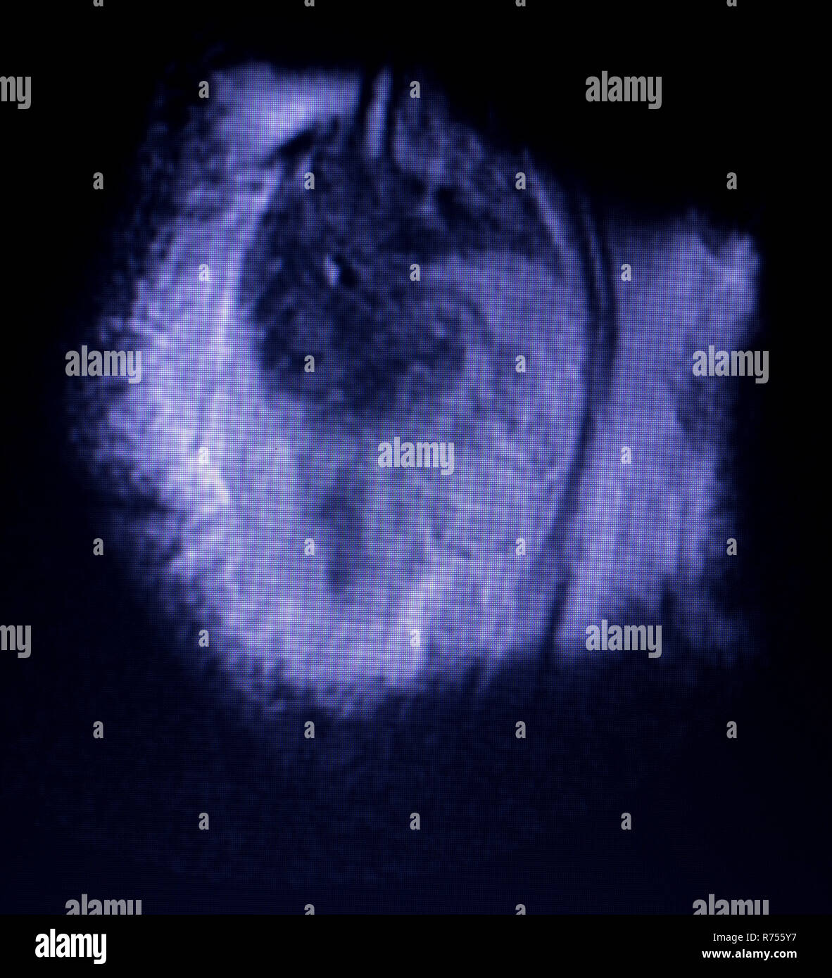 Magnetic resonance imaging MRI knee posterior horn medial meniscus tear ...