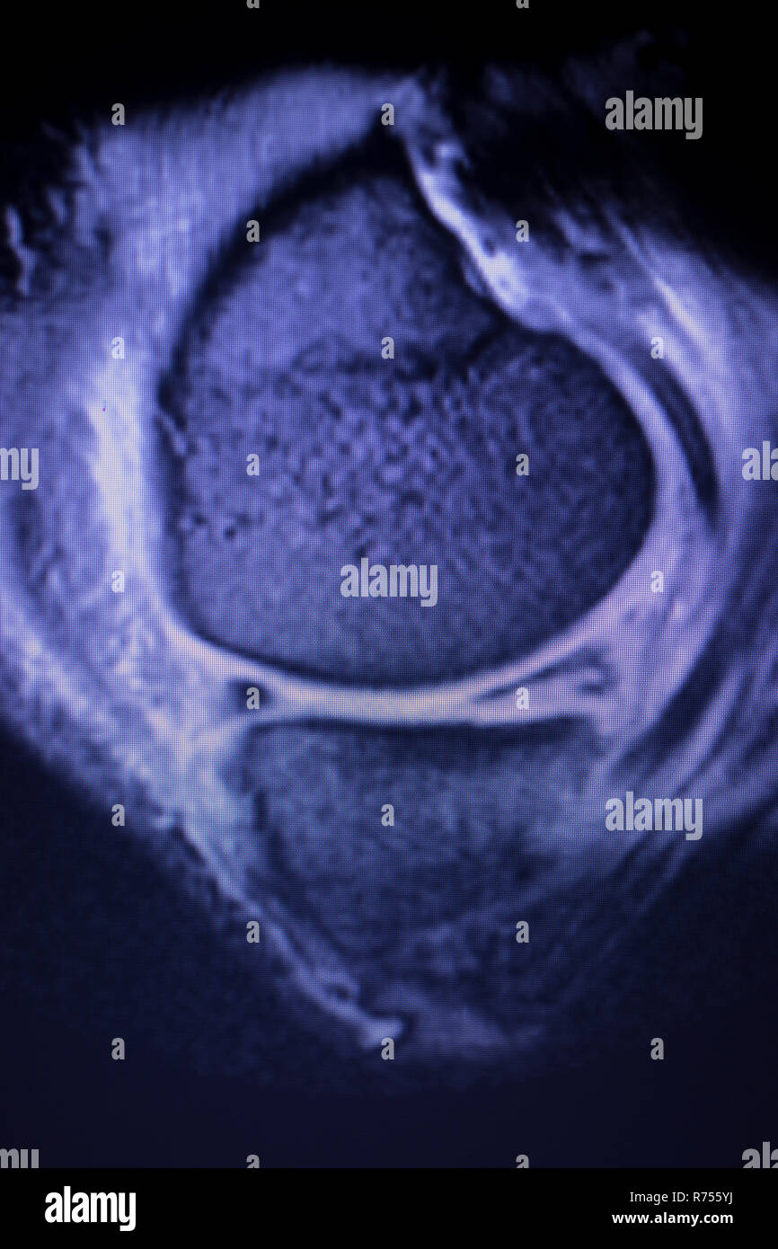 Magnetic resonance imaging MRI knee posterior horn medial meniscus tear ...