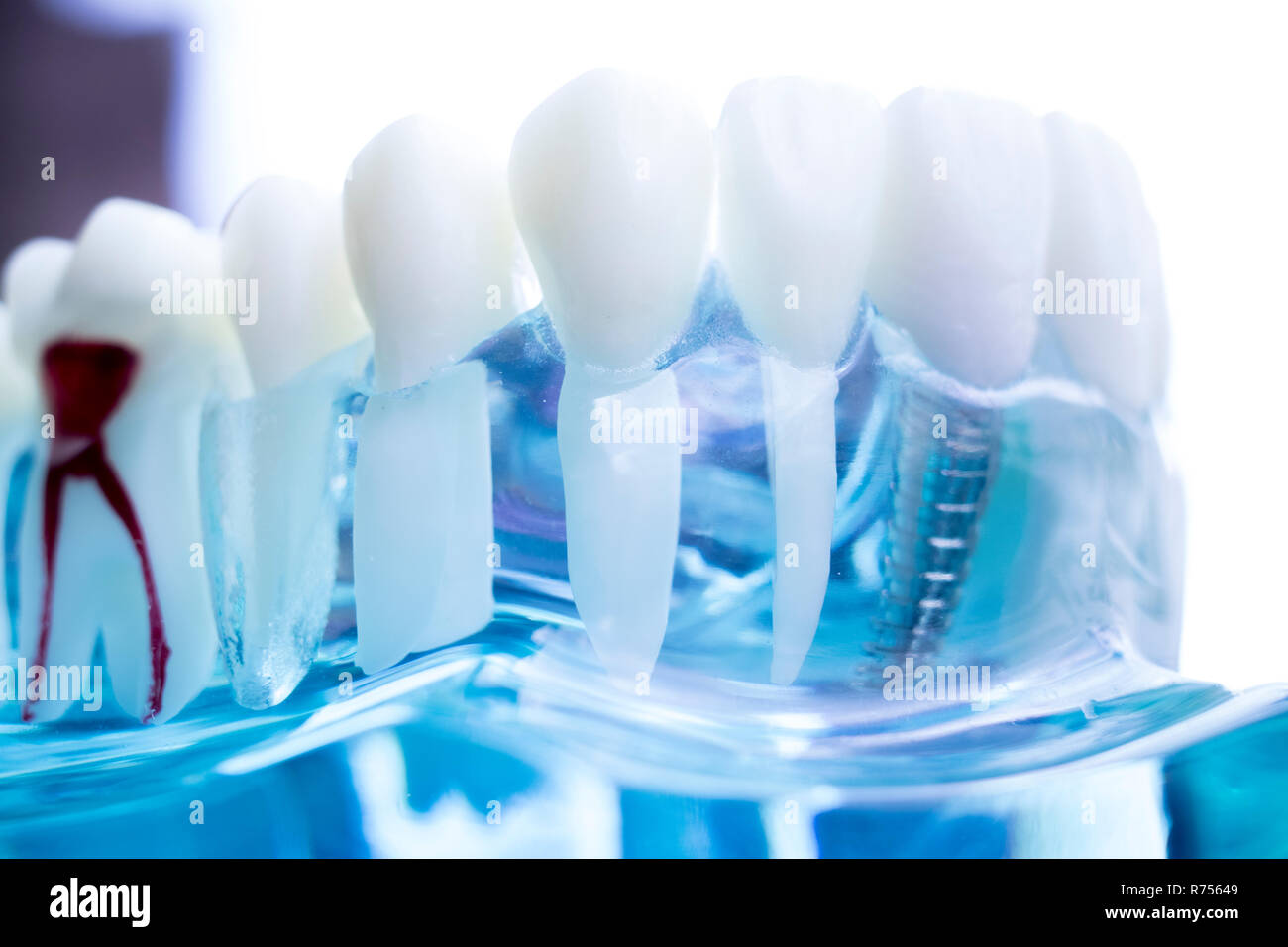 Dentist dental teeth teaching model showing titanium metal tooth ...