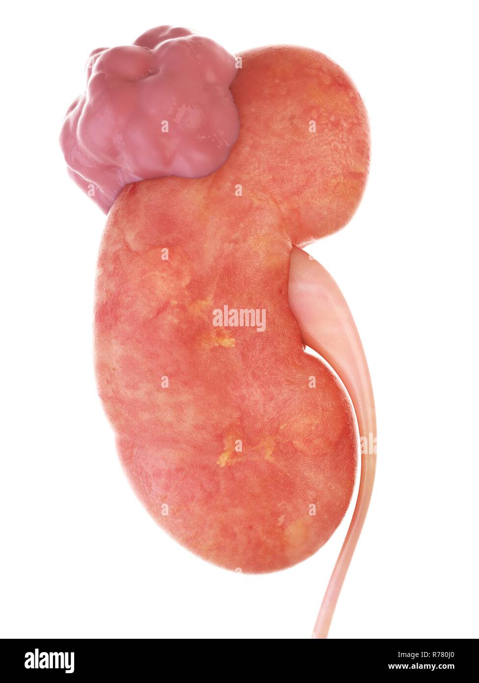 3d rendered illustration of kidney cancer Stock Photo - Alamy