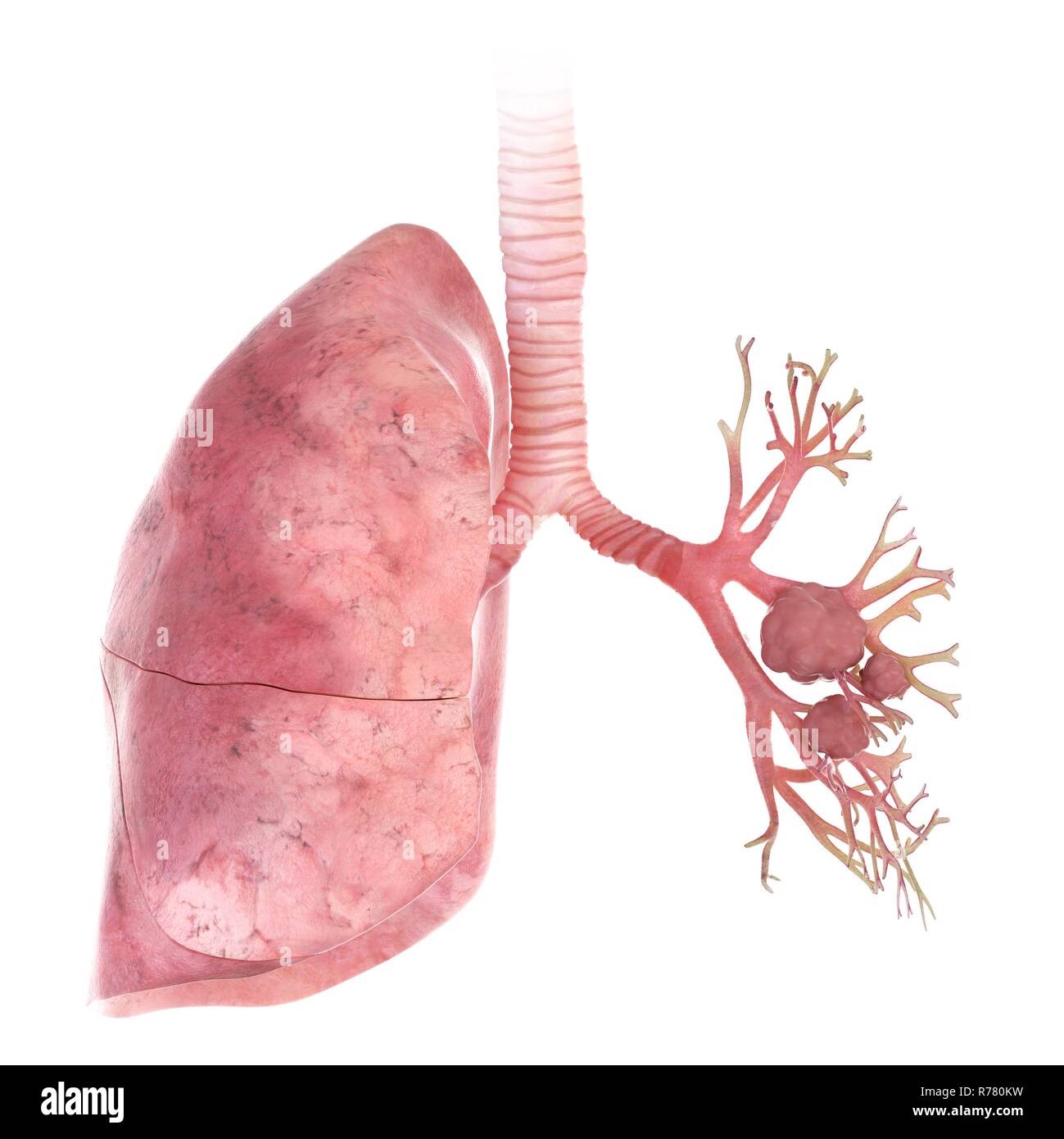 3d rendered illustration of lung cancer Stock Photo - Alamy