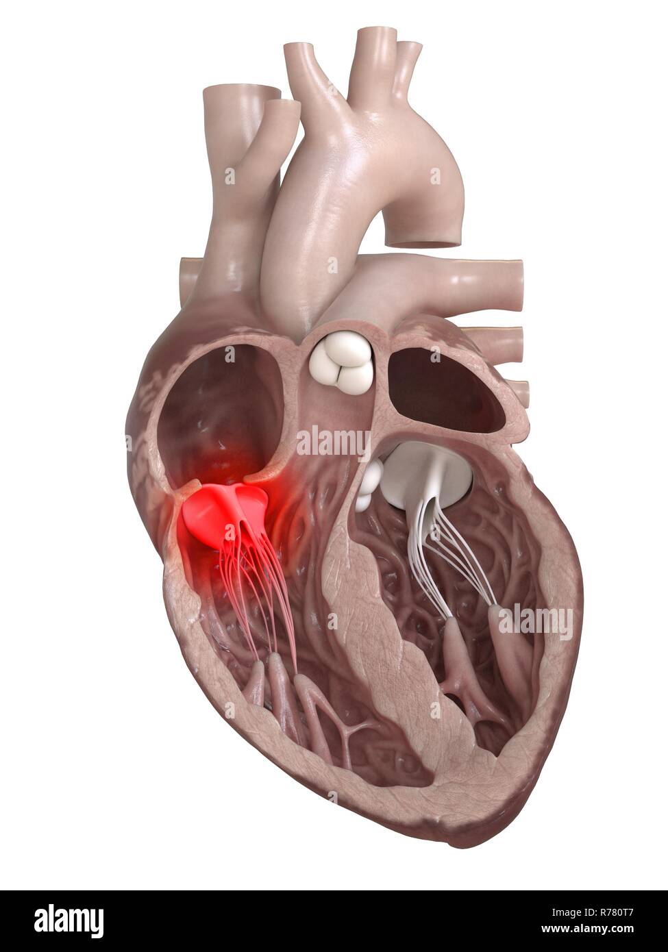 3d rendered illustration of a diseased heart valve Stock Photo - Alamy