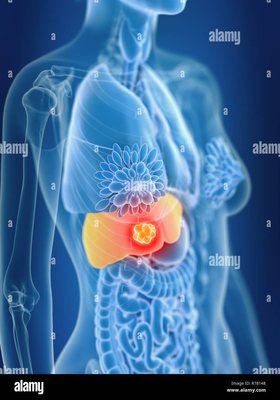 Female Liver Cancer High Resolution Stock Photography and Images - Alamy