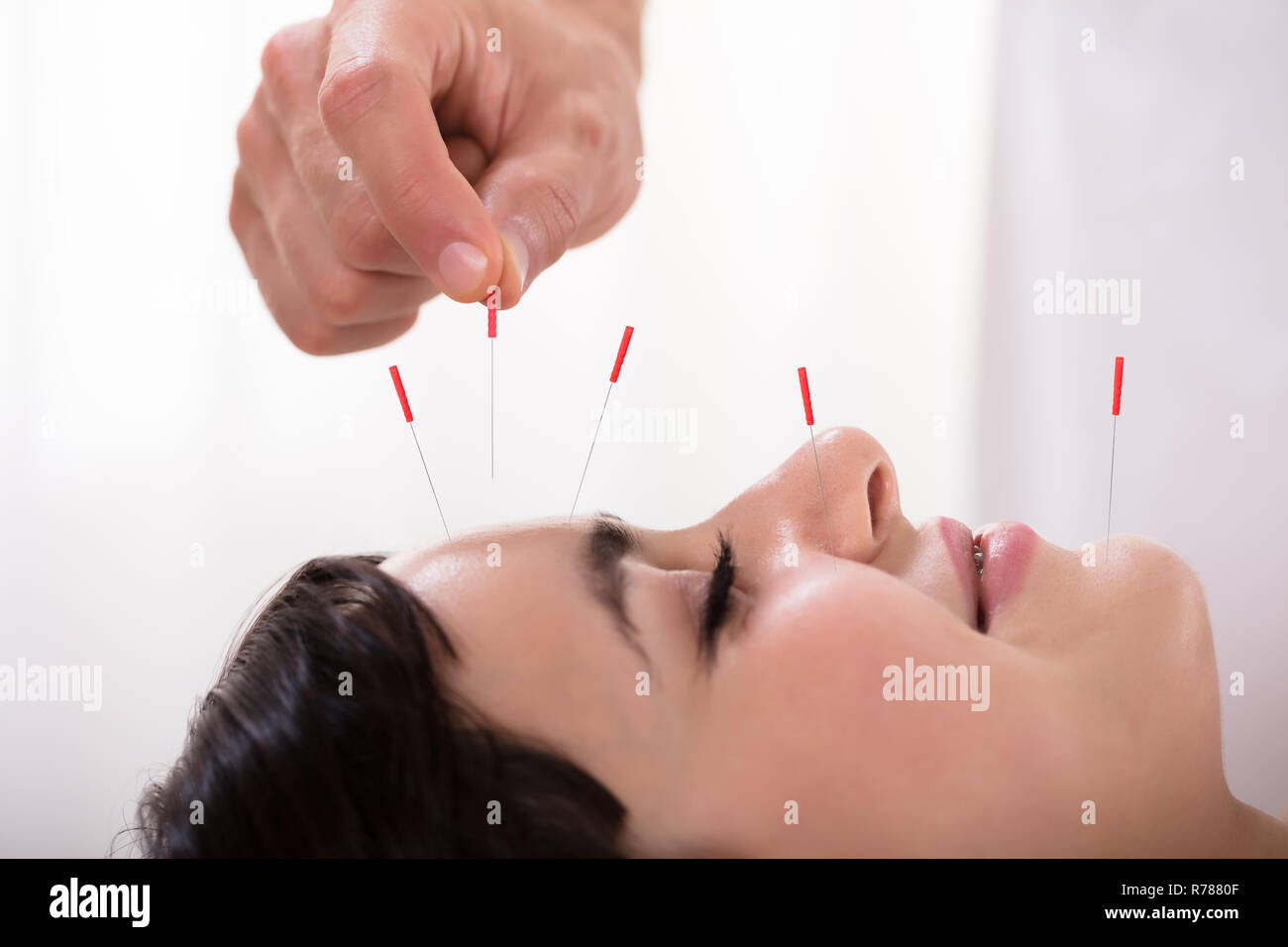 Beautiful Woman Getting Acupuncture Treatment Stock Photo - Alamy