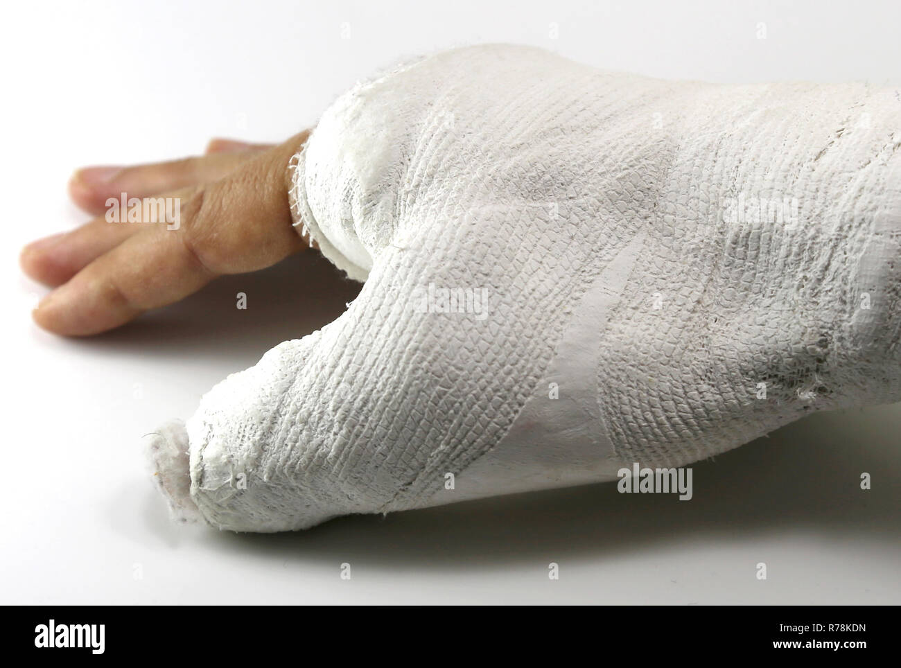 Plaster after wrist fracture hi-res stock photography and images - Alamy