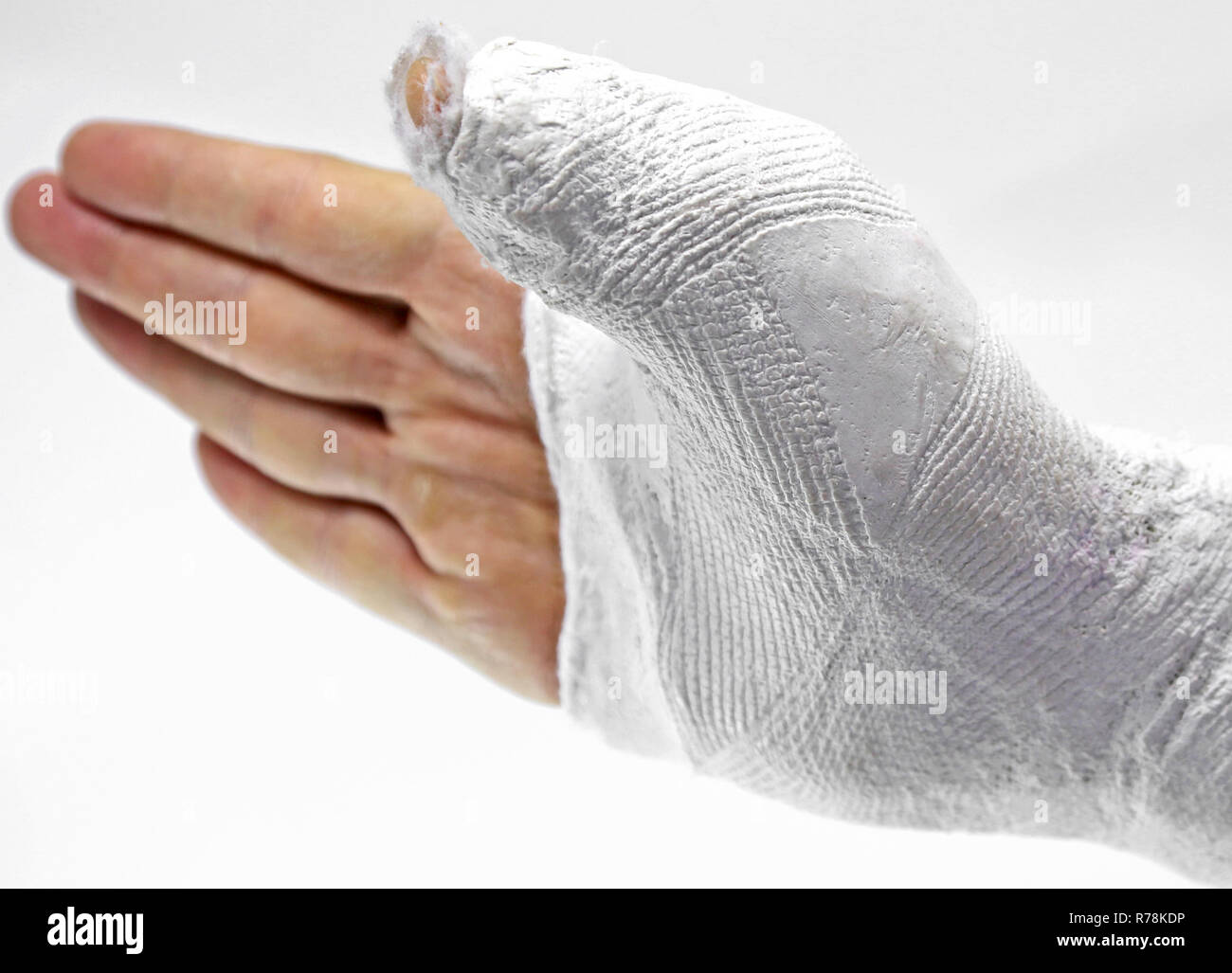 hand in the emergency room after the fracture of the thumb due to an ...