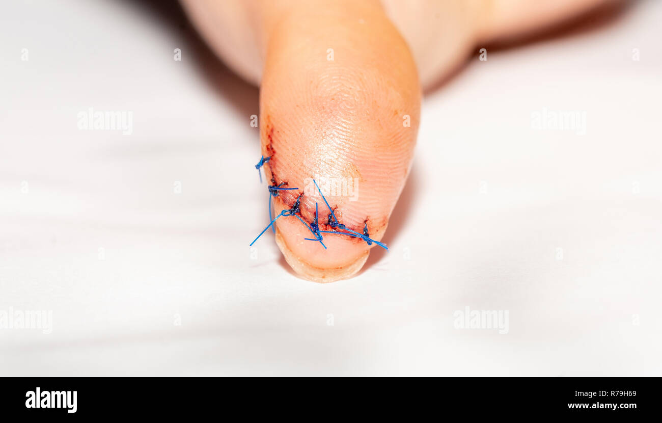 Cut Finger Stock Photos & Cut Finger Stock Images - Alamy