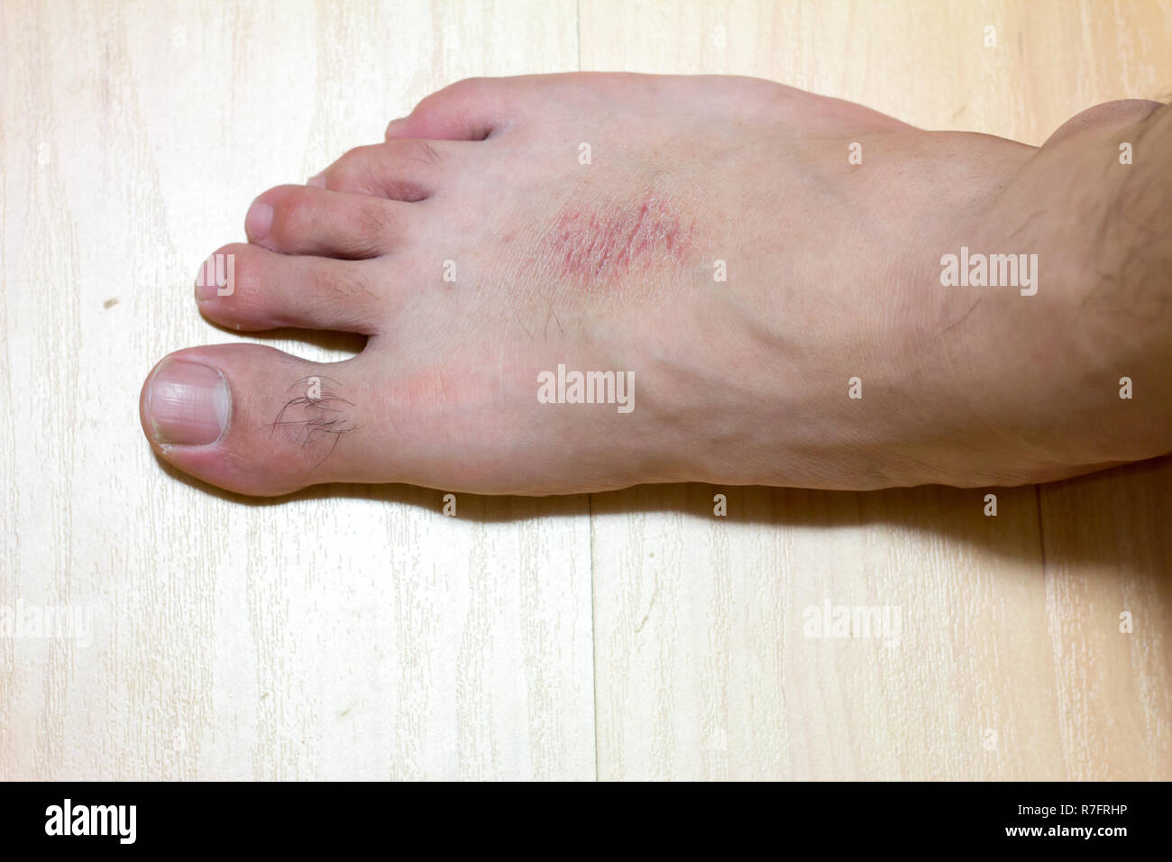 Dry skin and rash at male foot on wood background Stock Photo - Alamy