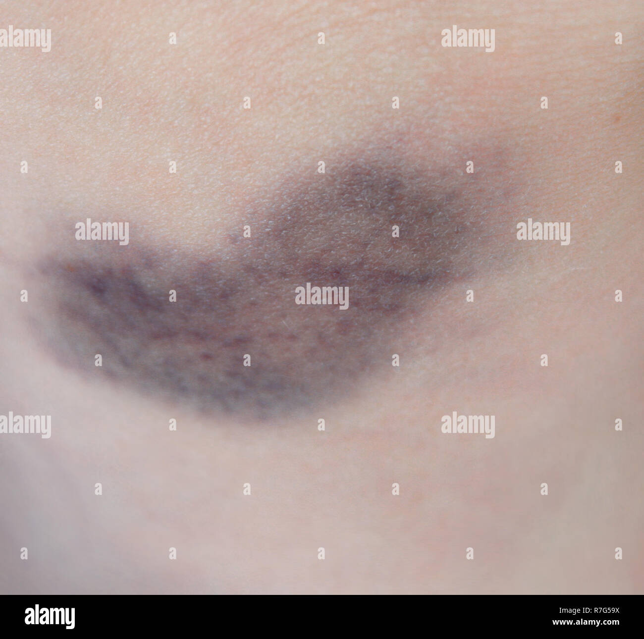 Bruise. Close-up photo Stock Photo - Alamy