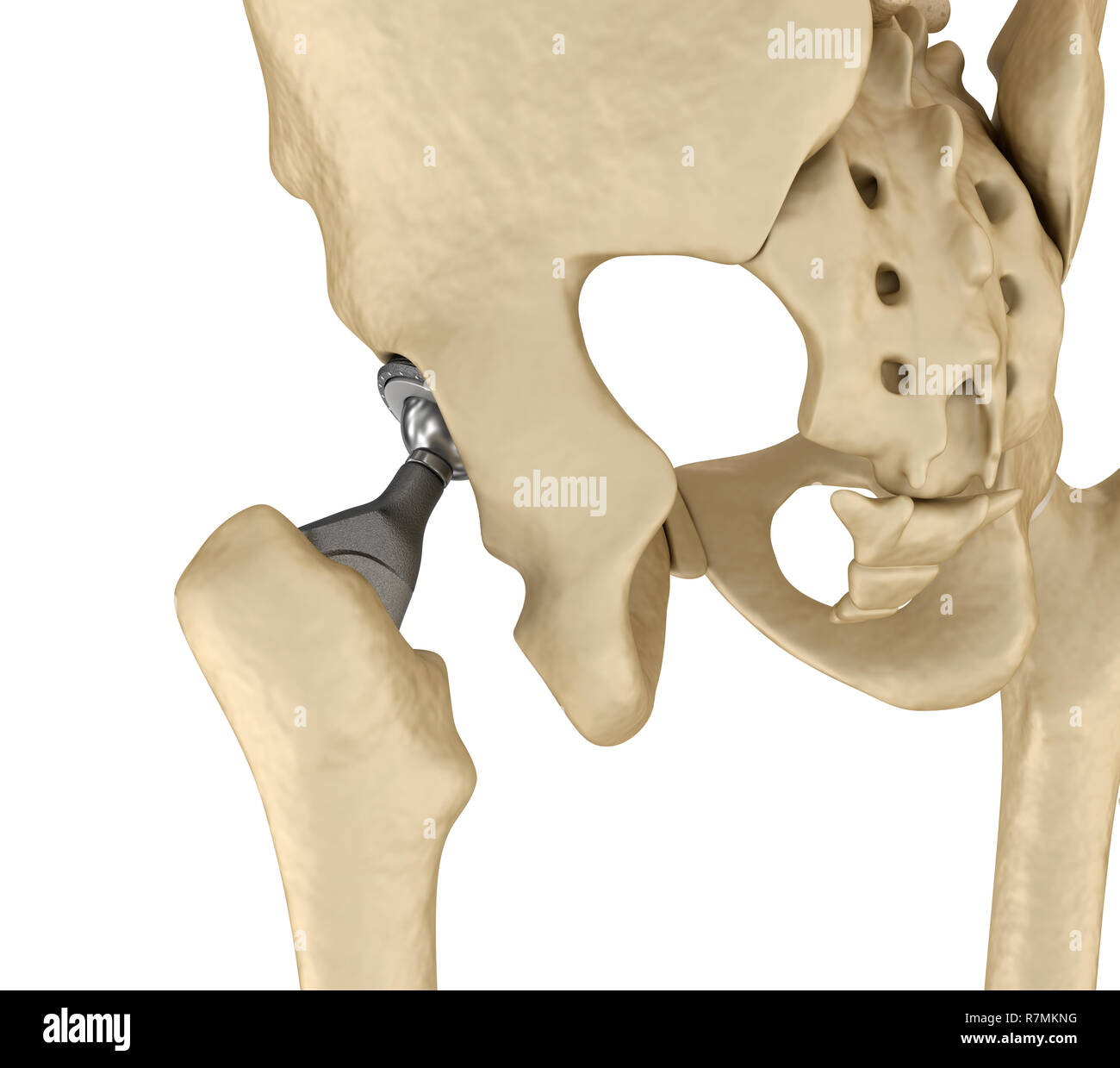 Hip replacement implant installed in the pelvis bone. Medically ...