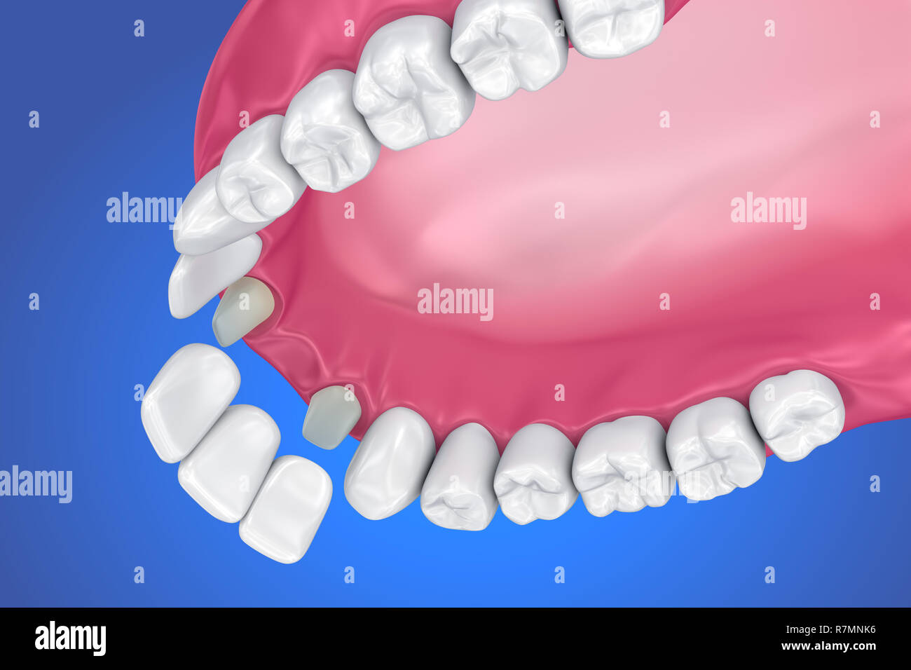 Tooth supported fixed bridge. Medically accurate 3D illustration Stock ...