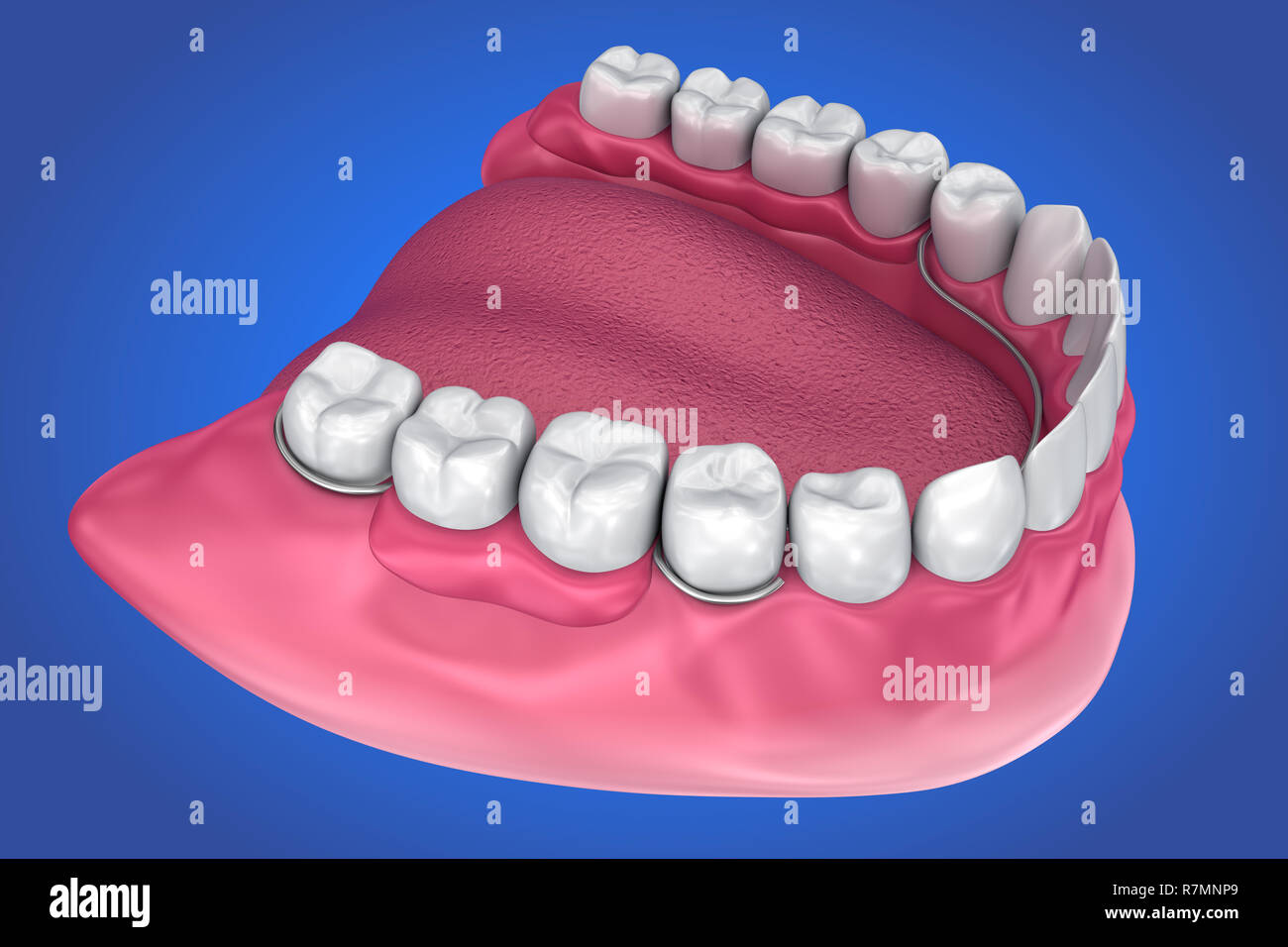 Removable partial denture. Medically accurate 3D illustration Stock ...