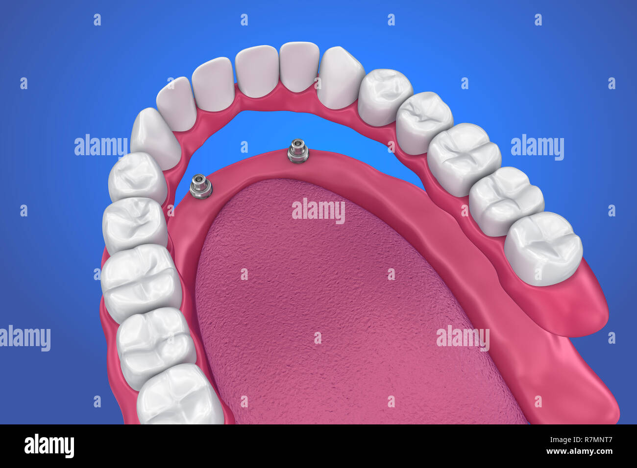 Fixed bridge on implants. Medically accurate 3D illustration Stock ...