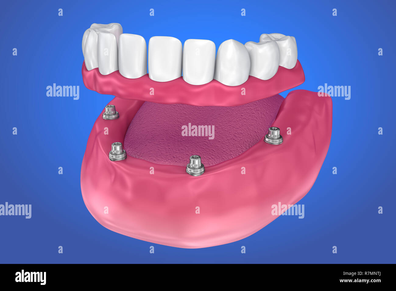 Fixed bridge on implants hi-res stock photography and images - Alamy