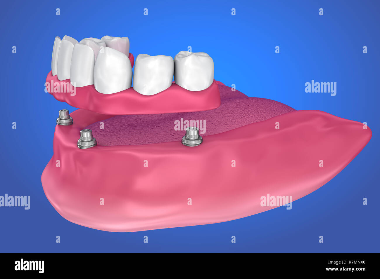 Fixed bridge on implants hi-res stock photography and images - Alamy