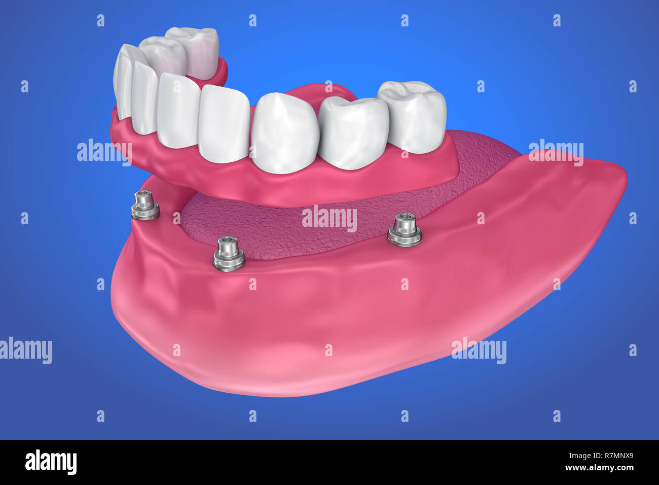 Fixed bridge on implants. Medically accurate 3D illustration Stock ...