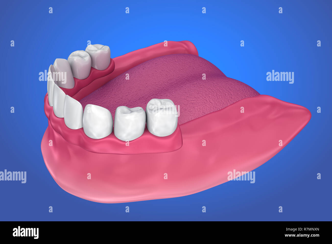Fixed bridge on implants. Medically accurate 3D illustration Stock ...
