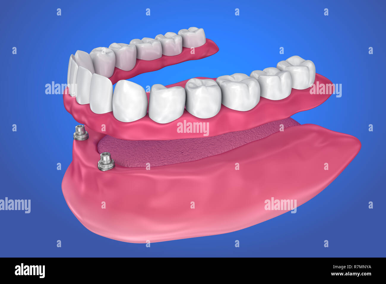 Fixed bridge on implants. Medically accurate 3D illustration Stock ...