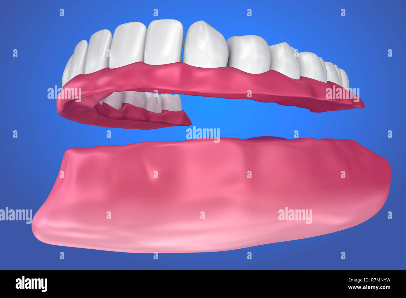 All missing teeth - removable full denture. 3D illustration Stock Photo ...