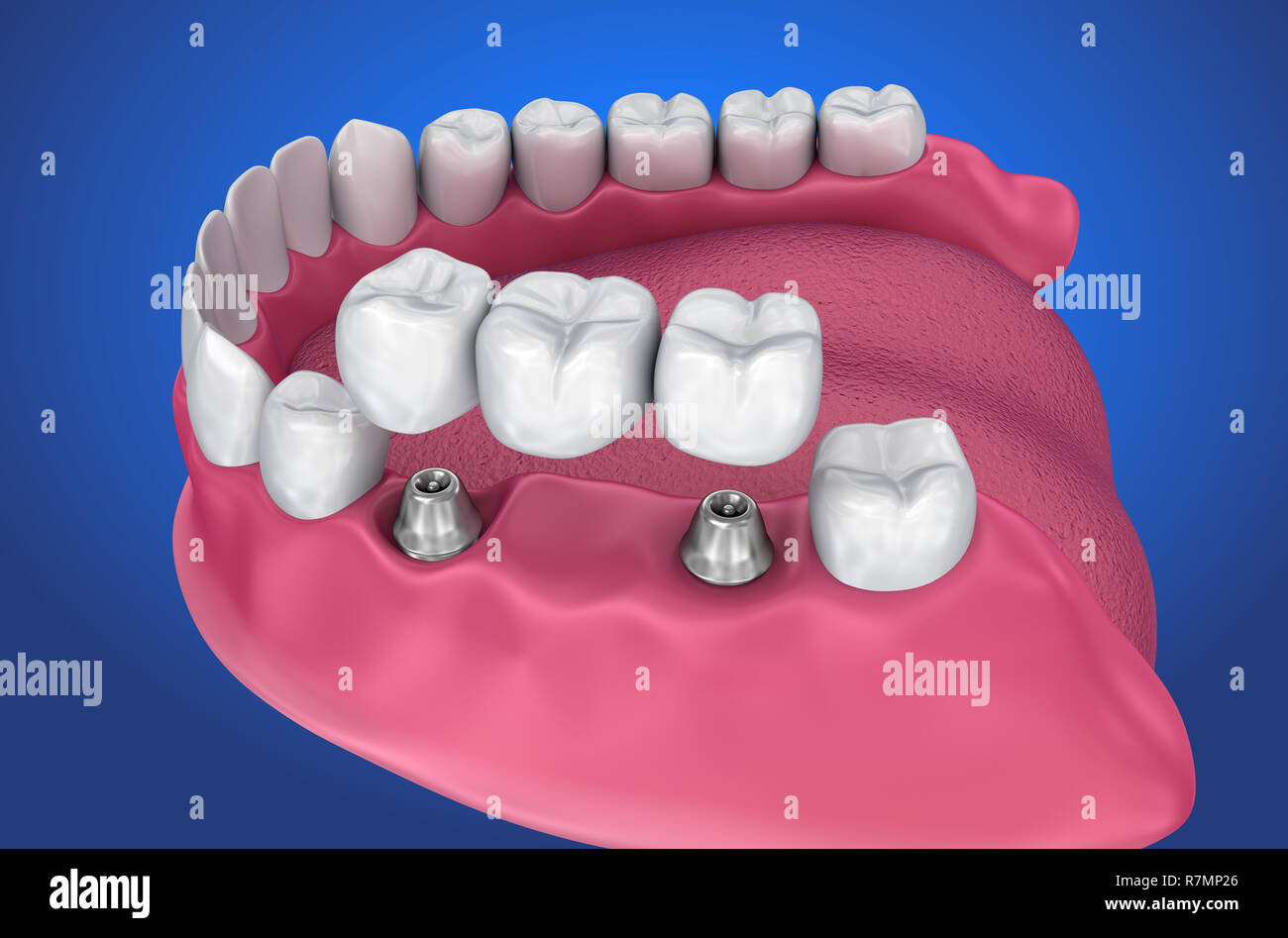 implant supported fixed bridge. Medically accurate 3D illustration ...