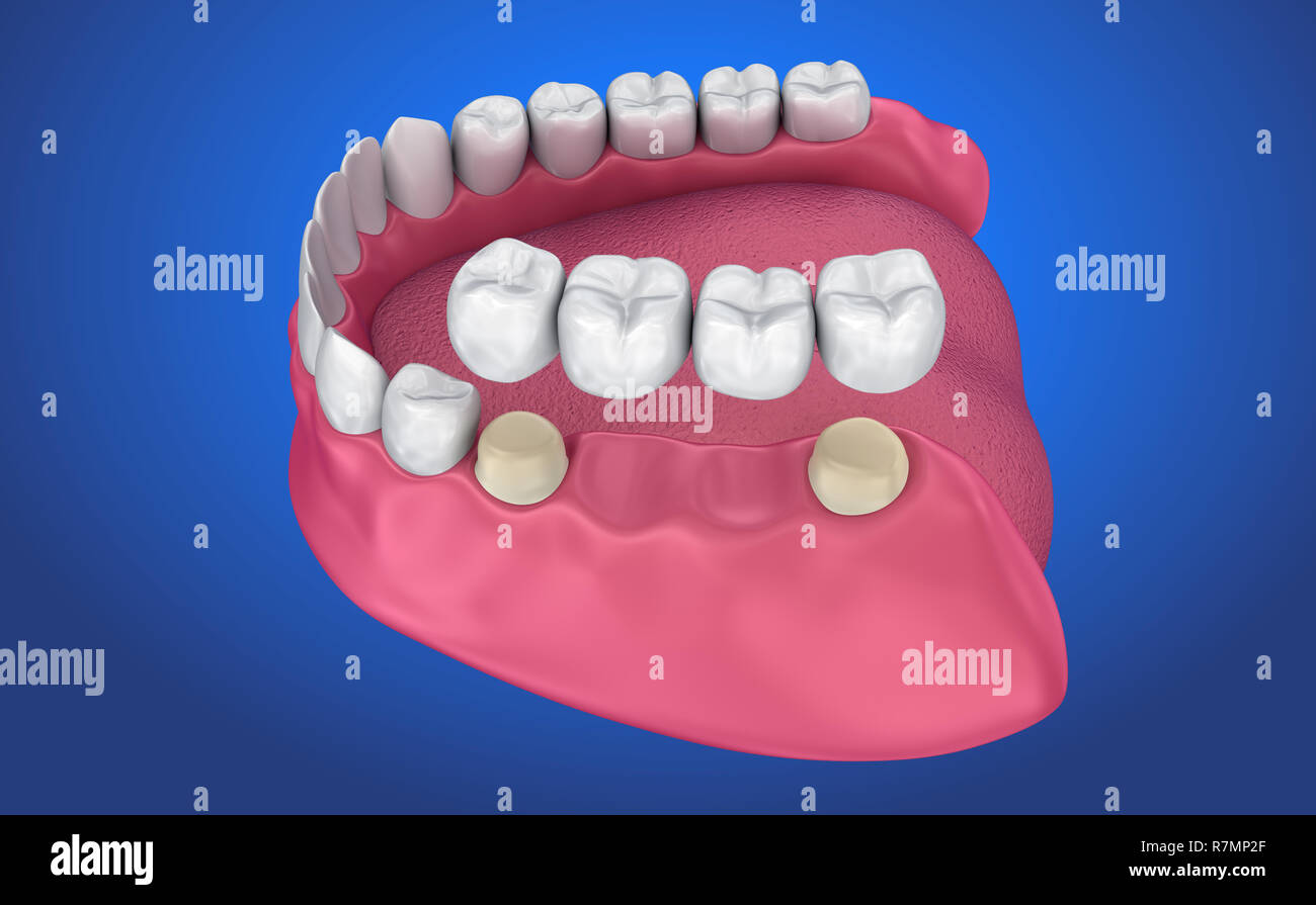Tooth supported fixed bridge. Medically accurate 3D illustration Stock ...