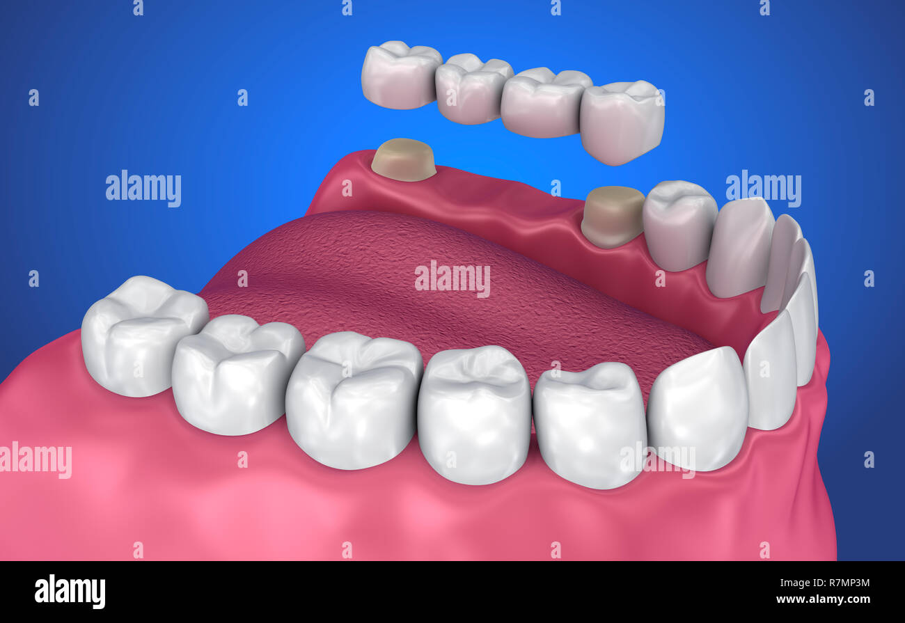 Tooth supported fixed bridge. Medically accurate 3D illustration Stock ...