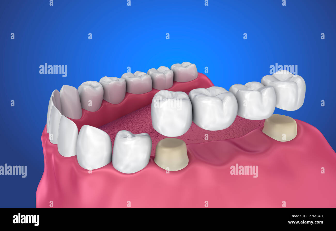 Tooth supported fixed bridge. Medically accurate 3D illustration Stock ...