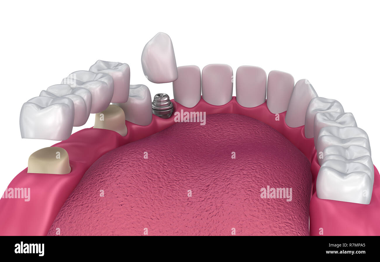 Tooth supported fixed bridge, implant and crown. Medically accurate 3D ...