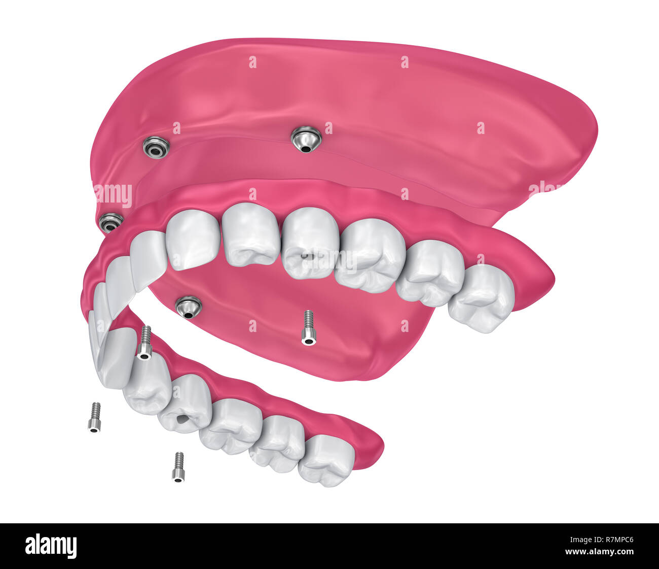 Overdenture to be seated on implants attachments. 3D illustration Stock ...