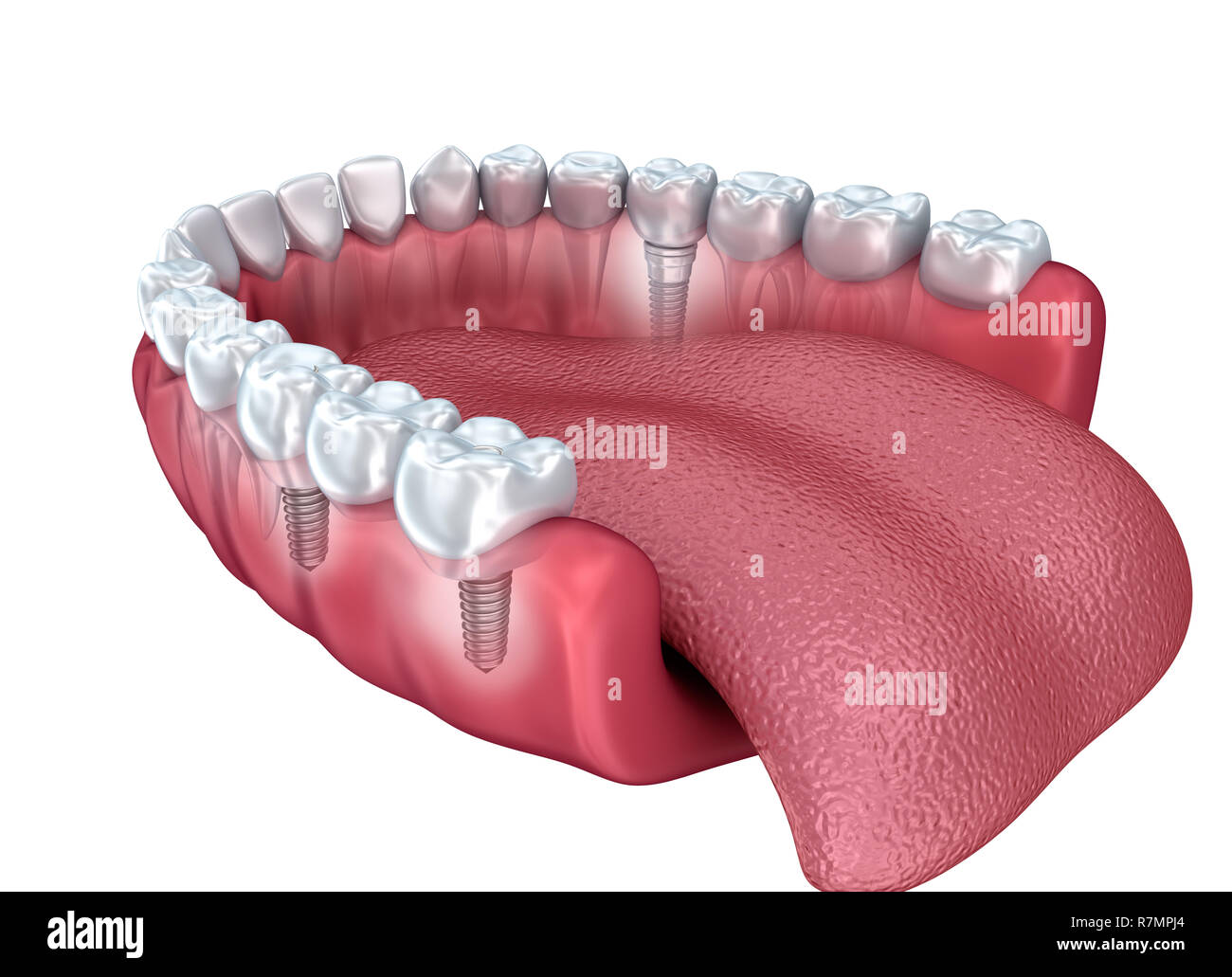 Lower teeth and dental implant transparent render isolated on white ...