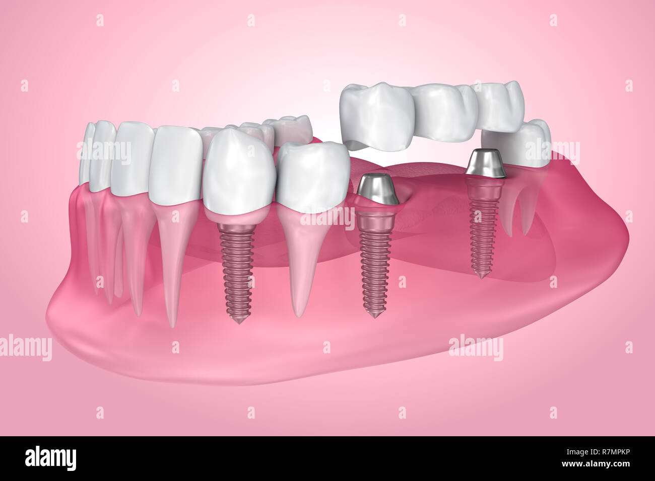 implant supported fixed bridge. Transparent view . Medically accurate ...