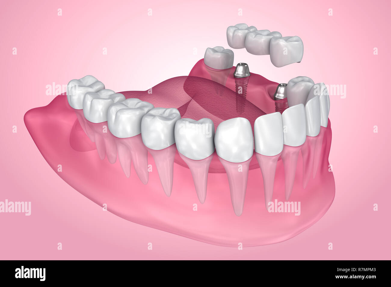 implant supported fixed bridge. Transparent view . Medically accurate ...